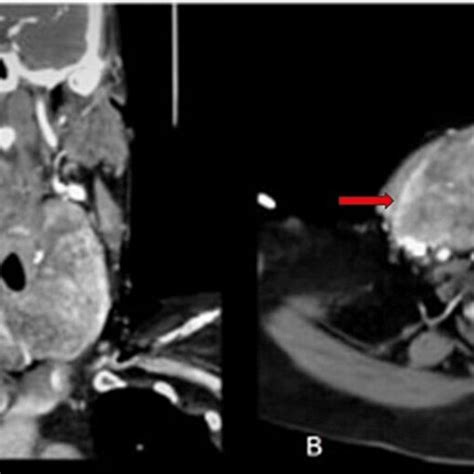 Ct Showing Enhanced Thyroid Mass Lesion A Coronal Ct Showing