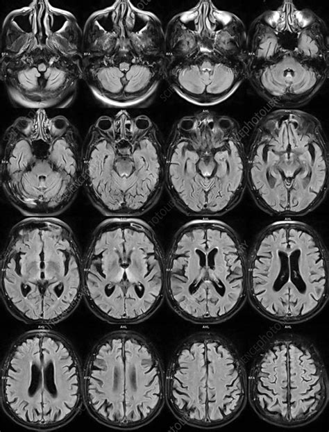 Brain Mri Scans Stock Image C0623677 Science Photo Library