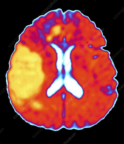 Stroke Mri Scan Stock Image M1360215 Science Photo Library
