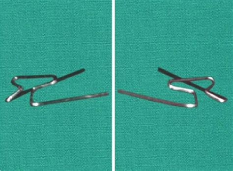 Antirotation Bends Of 35° In Each Leg Of The T Loops Download