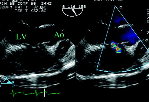 Membranous Vsd In Babies
