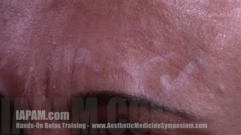 Iapam On Linkedin Iapam Botoxtraining Botox