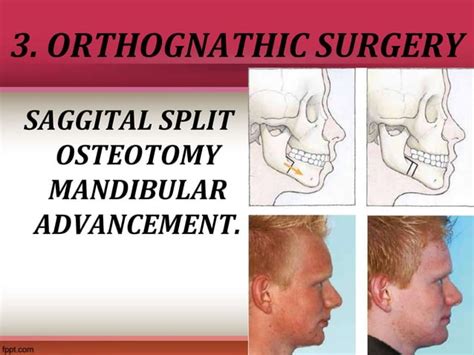 Treatment Of Class Ii Malocclusions Pptx