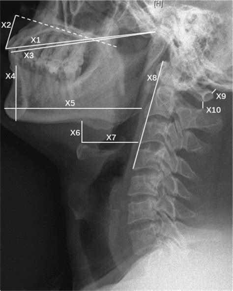 Distance Indicators On The Lateral Cervical X Ray In The Neutral