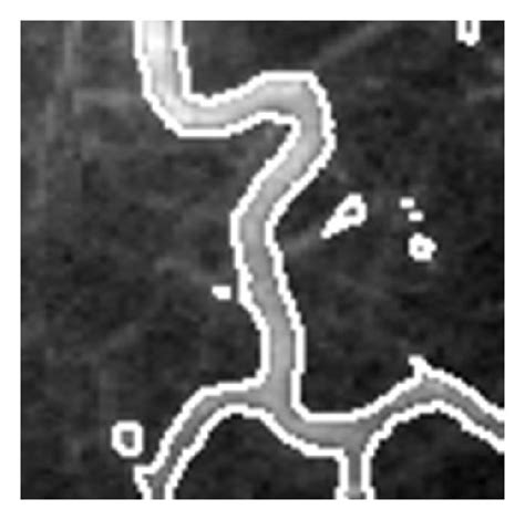 level set segmentation of the ct vessel by various initializations