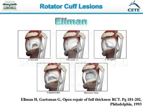Full Thickness Rotator Cuff Diagnosis And Management