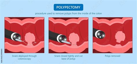 Polypectomy Procedure To Remove Polyps From The Colon Medical Stock