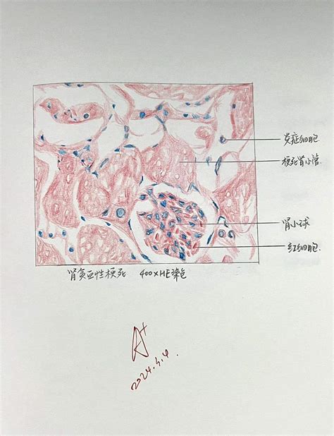 病理绘图｜肾贫血性梗死