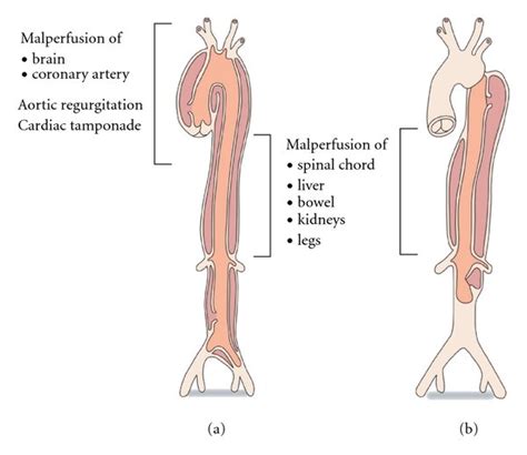 Subtypes And Complications Of Aortic Dissection A Type A And B