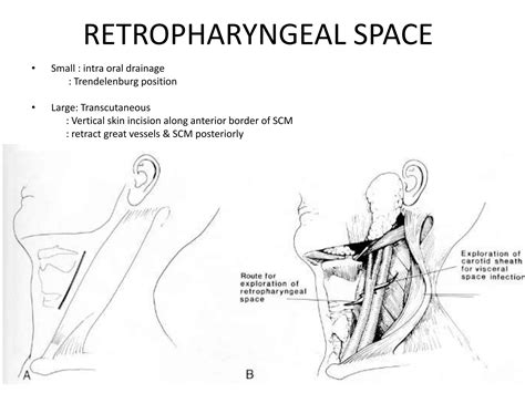 Srp Head And Neck Space Infections Ugpptx