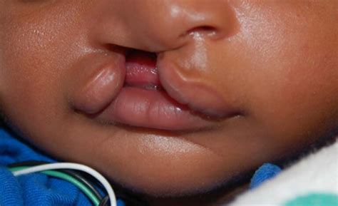 Cleft Lip And Cleft Lip Revision 4 Alaska Facial Plastic Surgery And Ent