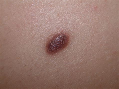 Dermatofibrom Lægehåndbogen På Sundheddk
