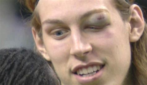 Dont Click This Unless You Want To See Kelly Olynyks Horrifically