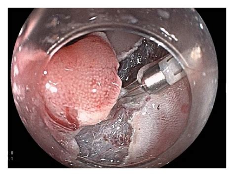 A Perforation During Dissection B The Perforation Was Closed By