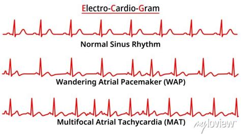 Set Of Ecg Common Abnormalities Wandering Atrial Pacemaker Posters
