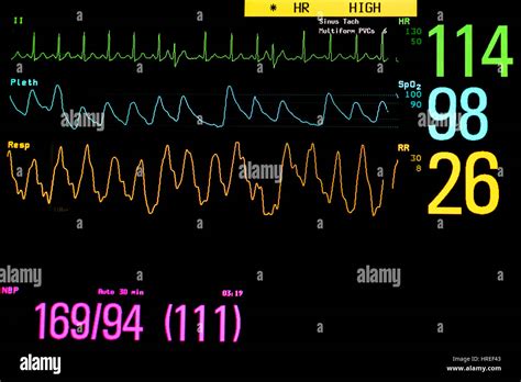 Icu Monitor Normal Range At Taylah North Blog