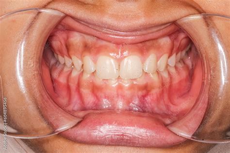 Plagát Frontal View Of Dental Maxillary And Mandibular Arches In
