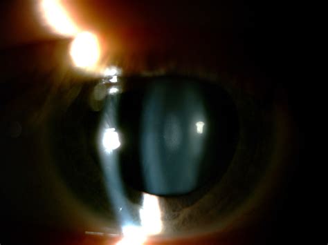 Granular Embryonic Nuclear Cataract And Genetic Mutation Researchgate