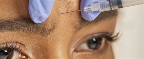 What Do Botox Injections Do A Comprehensive Guide