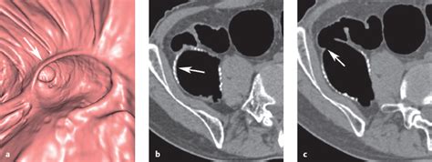 Ct Colonography For Surveillance After Colorectal Surgery Abdominal Key