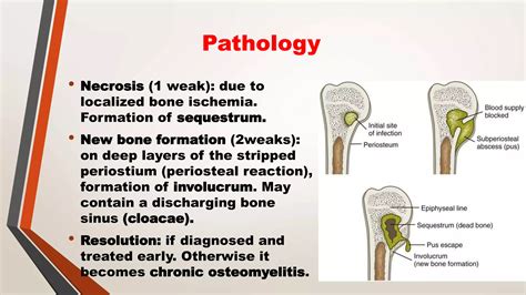 Bone Infections5 Th Stage Lecturedrfarouk Pptx Bone And Joint