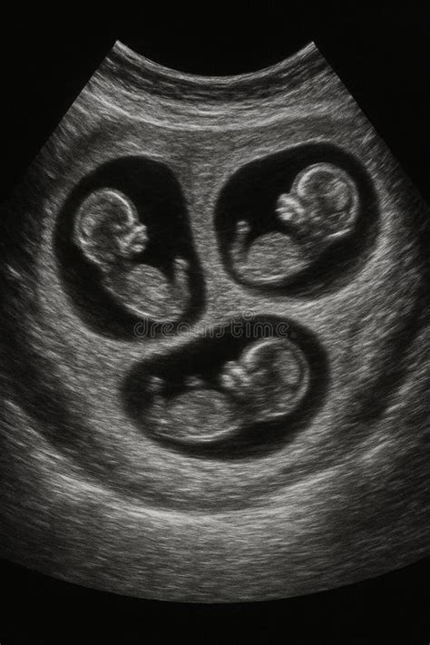 Embryos Triplets Stock Illustrations 1 Embryos Triplets Stock Illustrations Vectors And Clipart