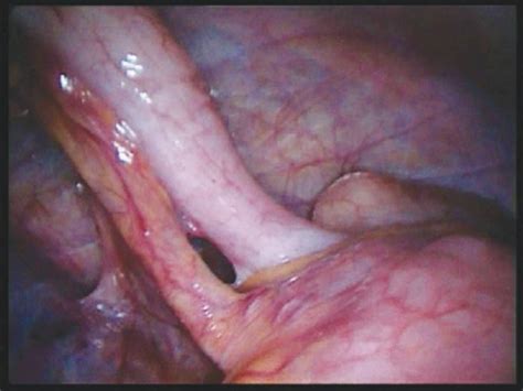 Avascular Space Between The Caecum The Appendix And The Mesoappendix Download Scientific Diagram