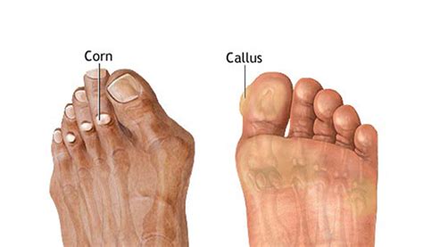What Causes Corn On Feet Seed Corn On Foot Identification Causes