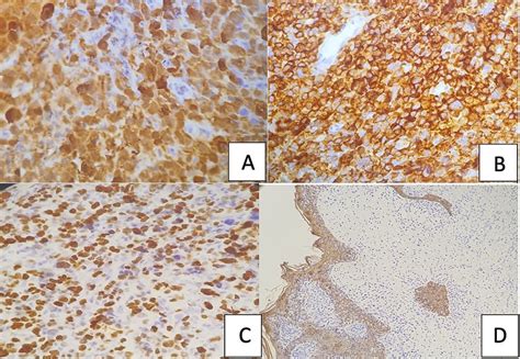 Langerhans Cell Lc Sarcoma Immunohistochemistry A S100 Was Widely