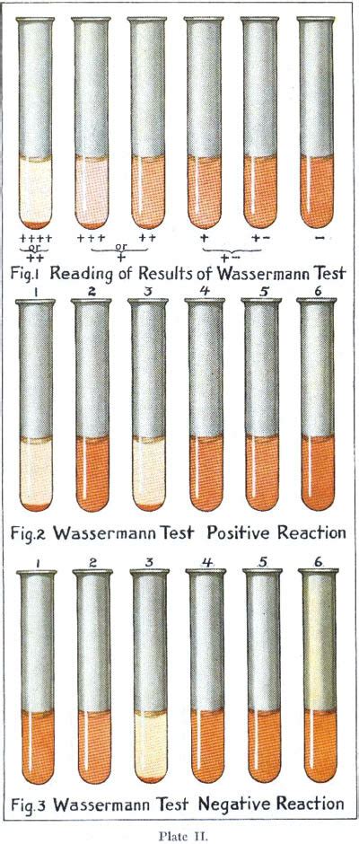 Reading Of Results Of The Wasserman Test Craig Charles Franklin The Download Scientific