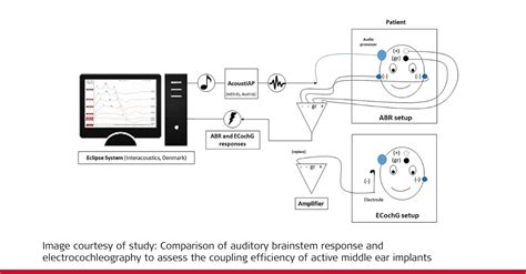 Med El On Linkedin Comparison Of Auditory Brainstem Response And