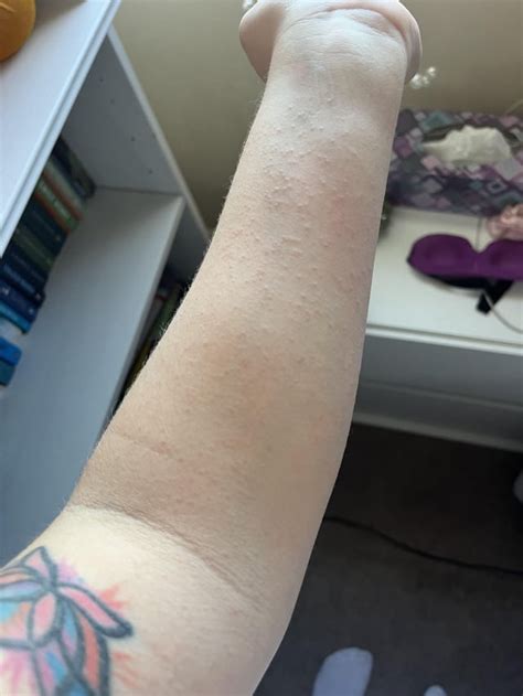 Rash Anyone Else Experienced This R Cymbalta