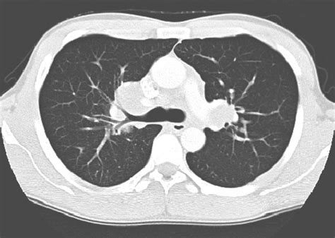 Ct Chest Demonstrating Bilateral Hilar Adenopathy Download