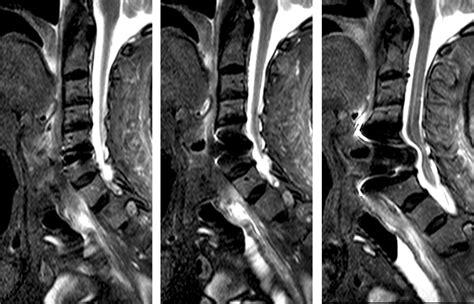 Assessment Of Magnetic Resonance Imaging Artifact Following Cervical