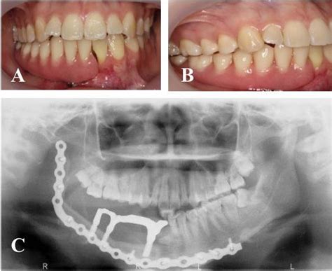 Final Definitive Prosthesis A Frontal View Of The Bar Supported Download Scientific Diagram
