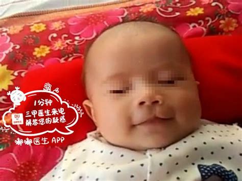 为什么姐姐二胎生了个兔唇宝宝 搜狐