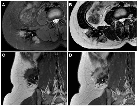 Figure 1 From Subcutaneous Desmoid Tumors Characteristic Sun Burst