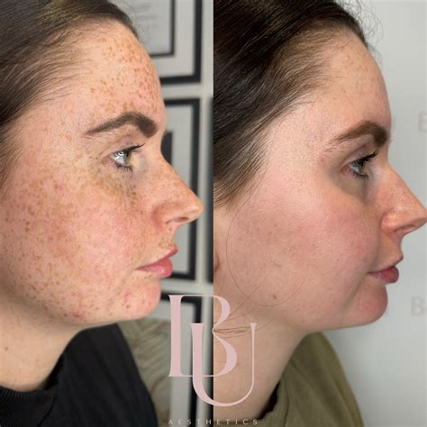 Bu Hyperpigmentation Vs Freckles Whats The Difference