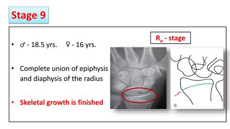 Skeletal Maturity Indicator Short Pptx