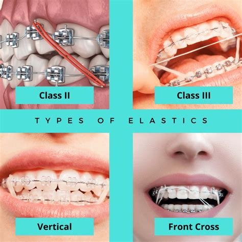 Do Elastics On Braces Work At Terrie Wesley Blog