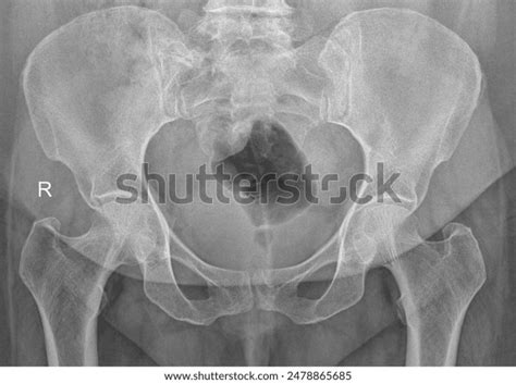 Pelvic Trauma Assessment Photos Images And Pictures Shutterstock