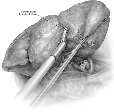 Uniportal Video Assisted Thoracoscopic Right Upper Lobectomy Operative Techniques In Thoracic