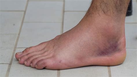 Sprained Ankle Symptoms And Causes Of Ankle Sprain Explained