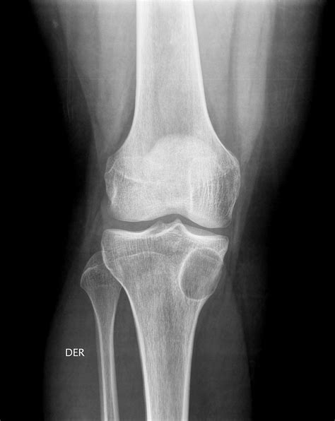 Anatomía De La Radiografía De La Rodilla Radiografía De Rodilla Ap
