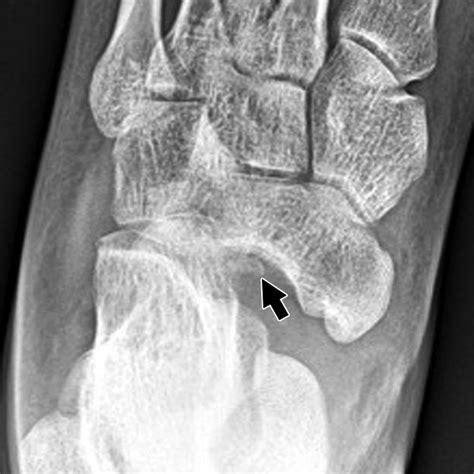 Calcaneocuboid Dislocation