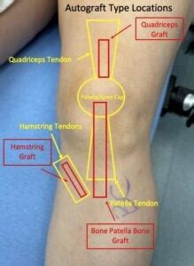 Anterior Cruciate Ligament Grafts Ortho Rhode Island