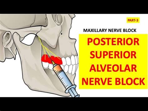 Superior Alveolar Nerve Block عن طب الأسنان Aboutdent On