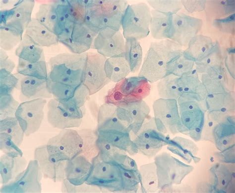 Understanding Ascus A Guide To Gyn Cytology And Pap Smear