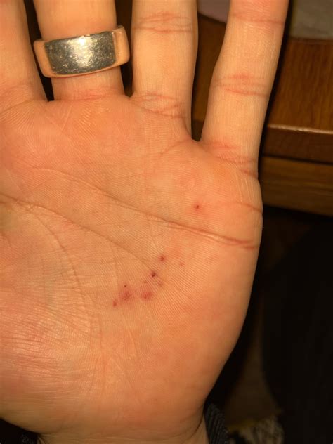 Petechiae Leukemia Symptoms