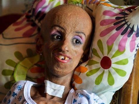 Progeria